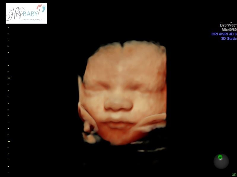 Hd Ultrasound 28 Weeks